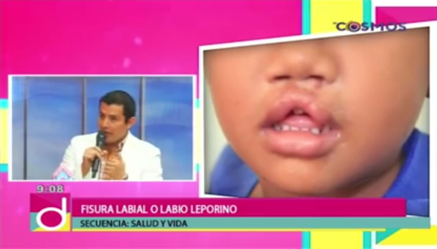 Fisura labial o labio leporino - Noticias del Perú, del mundo, marinera ...